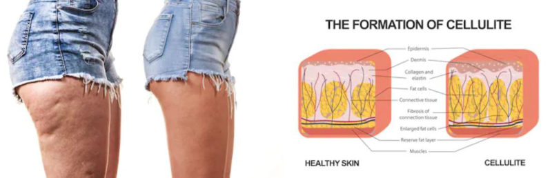 What is Cellulite? - Joveen.com